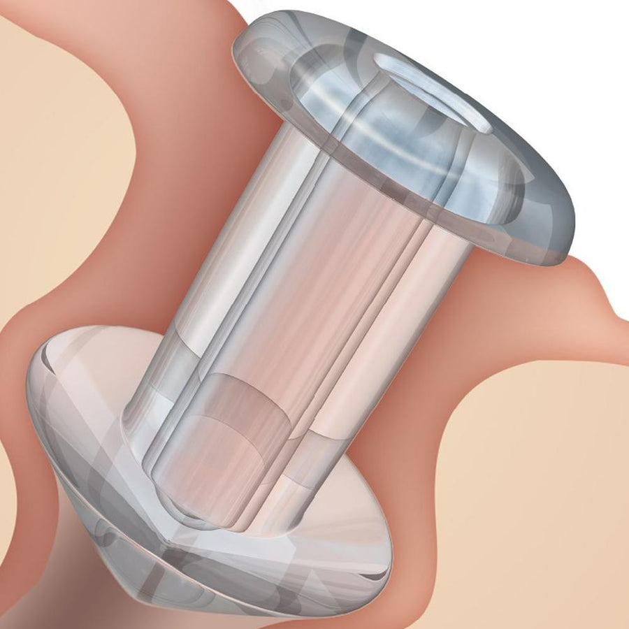 Punctal Plugs Treatment